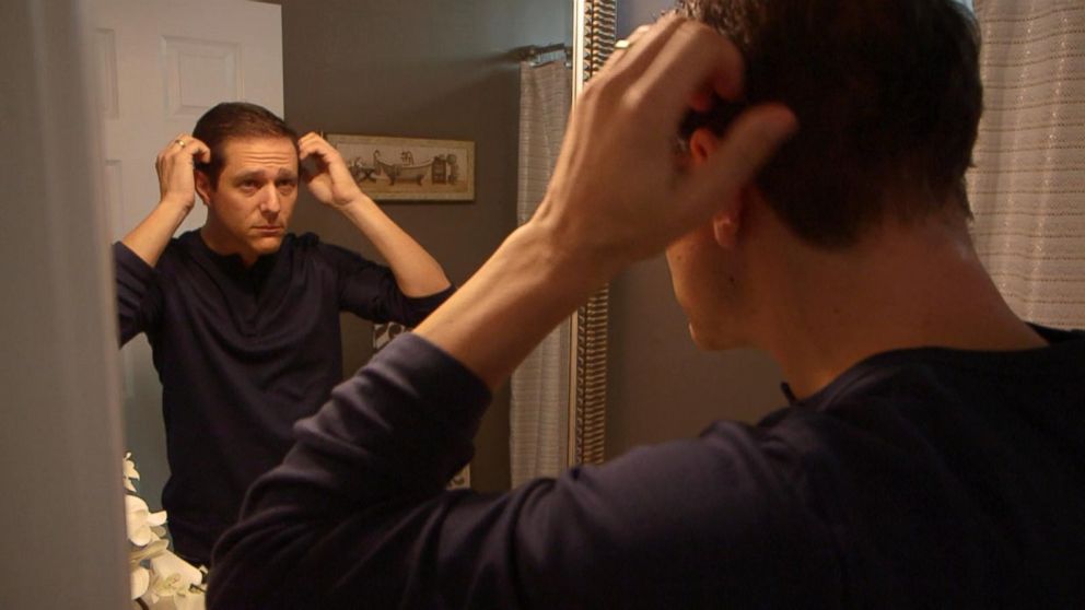 New Drug For Alopecia Shows Promise What You Need To Know Abc News