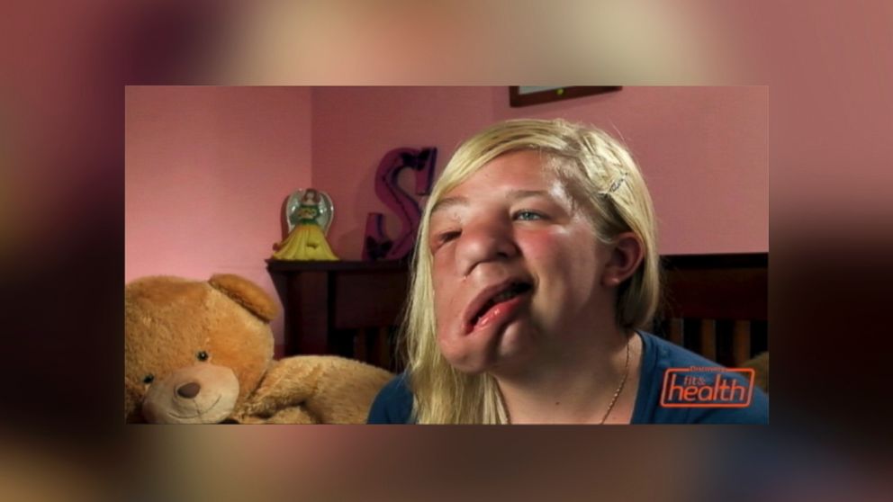 Teen With Half a Face Stands Up to Her Bullies - ABC News