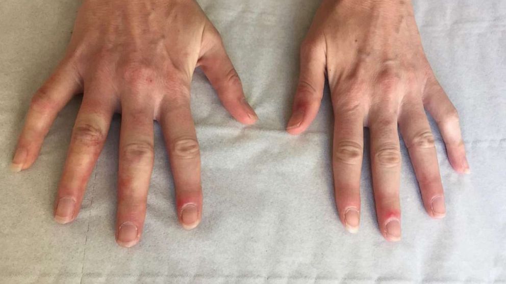 COVID Toes Could Skin Conditions Offer Coronavirus Clues Good COVID Toes Could Skin Conditions Offer Coronavirus Clues Good