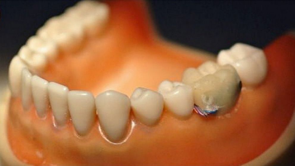 Princeton University Tooth Tattoos
